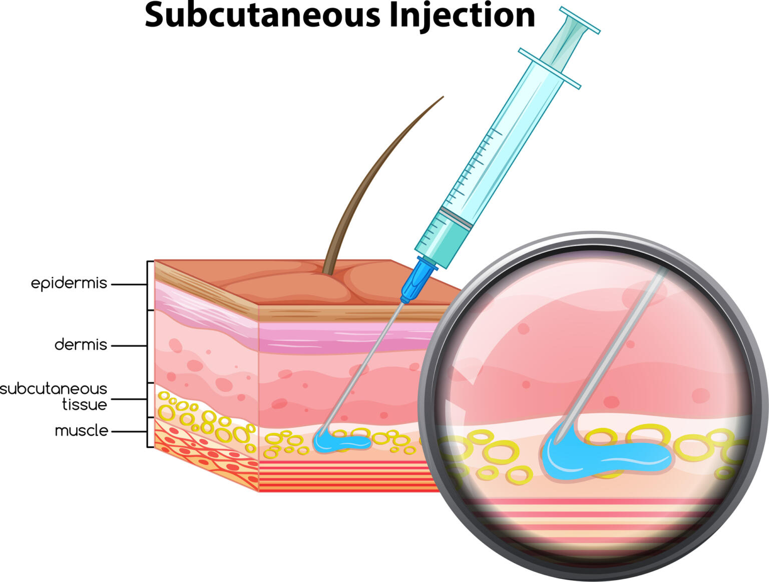 Understanding IVIG and SCIG Treatments | Soleo Health